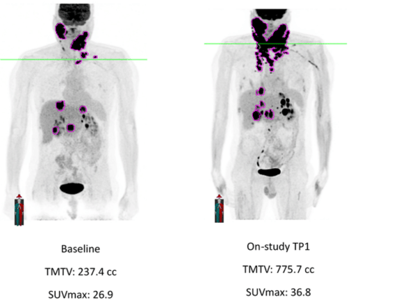 Total metabolic tumor volume — A valuable new method of assessment of ...